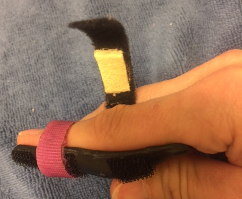 Chapter 6: Camptodactyly - APPI America