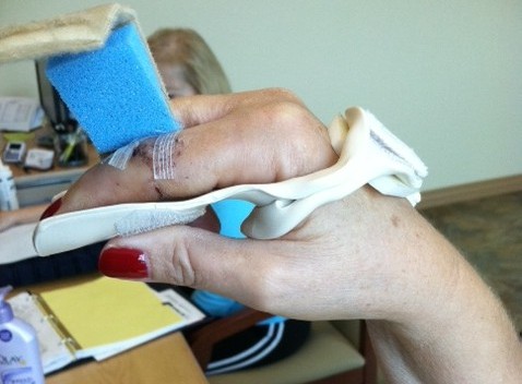 Chapter 6: Camptodactyly - APPI America