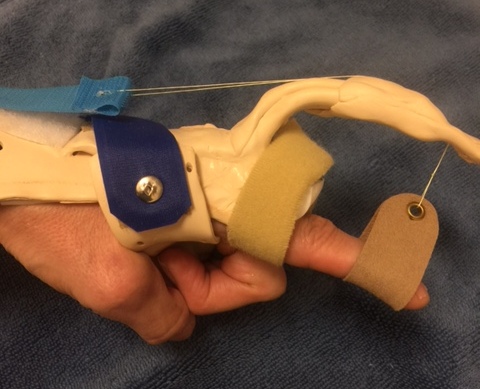 Chapter 6: Camptodactyly - APPI America